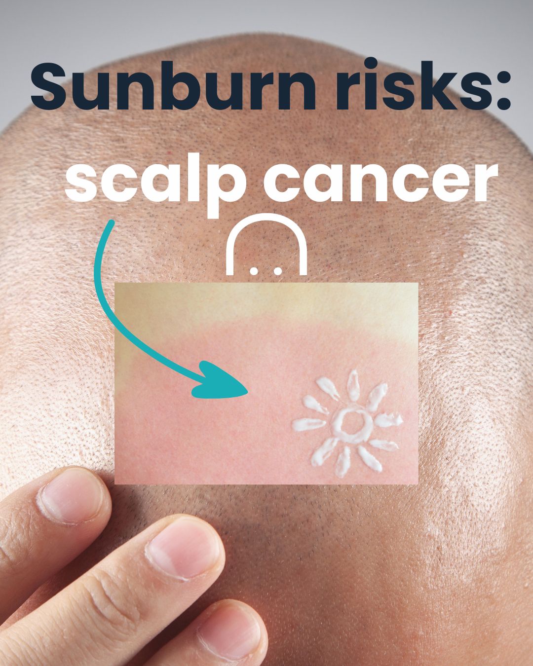 Scalp Cancer in Bald Men: Understanding the Risks of Sunburn and How t ...